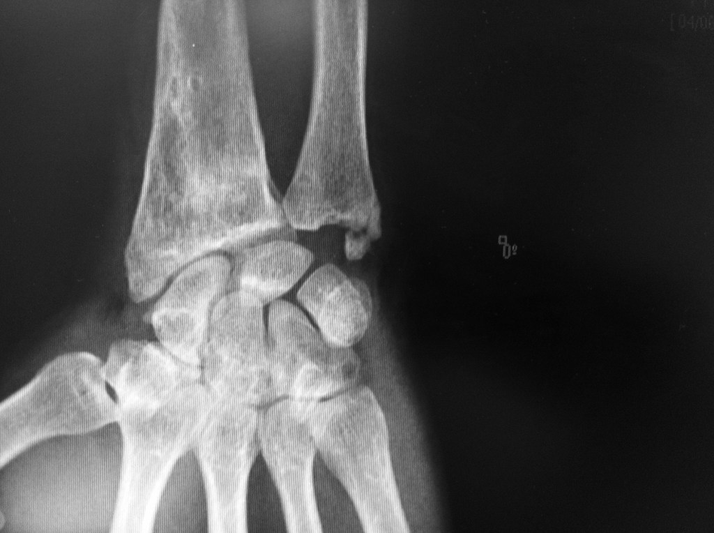 Cómo valorar radiológicamente la articulación radiocarpiana? | Dra ...